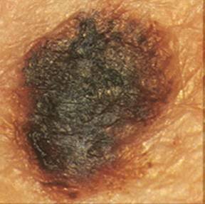 Skin imaging methods for melanoma diagnosis - Do It Easy With ScienceProg